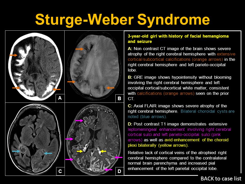 Tramline Intracranial Calcifications