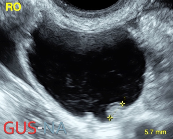 What is a SOLID PAPILLARY PROJECTION on ultrasound? Continuing our ...