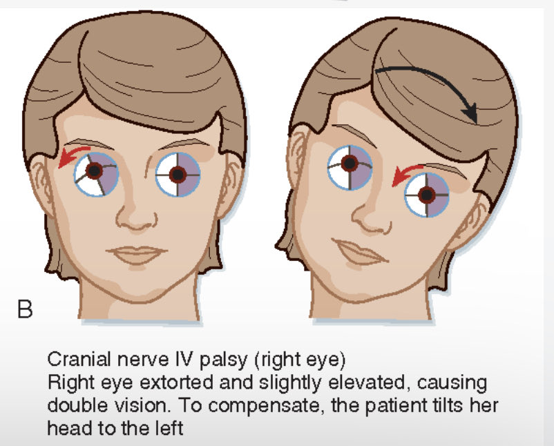 Cranial Nerve 4 Palsy