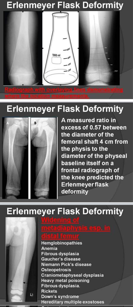 Erlenmeyer Flask Deformity
