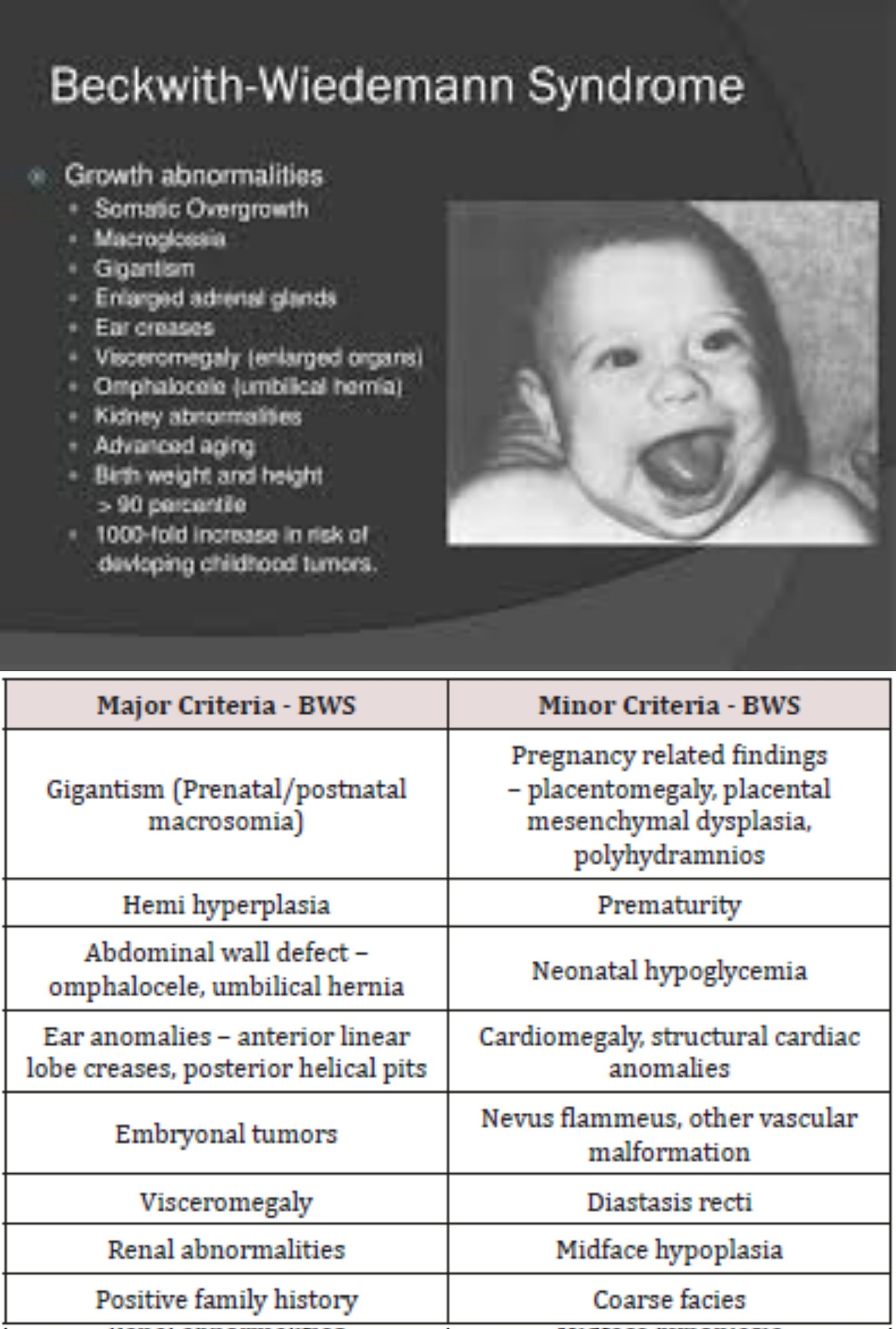 Beckwith Wiedemann Syndrome Ear