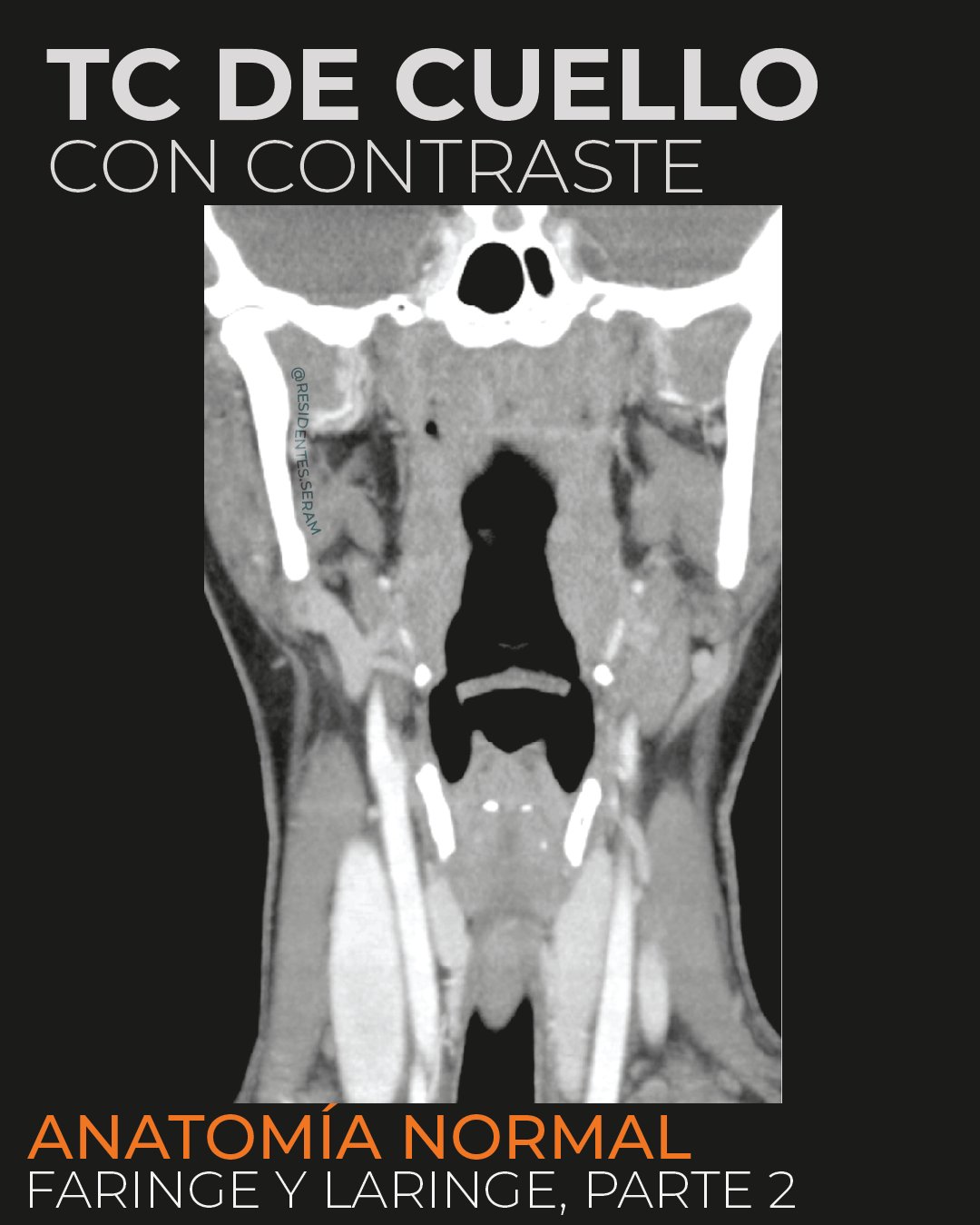 Anatomía Del Cuello Por Tc 06. Vísceras Del Cuello | Enfermería