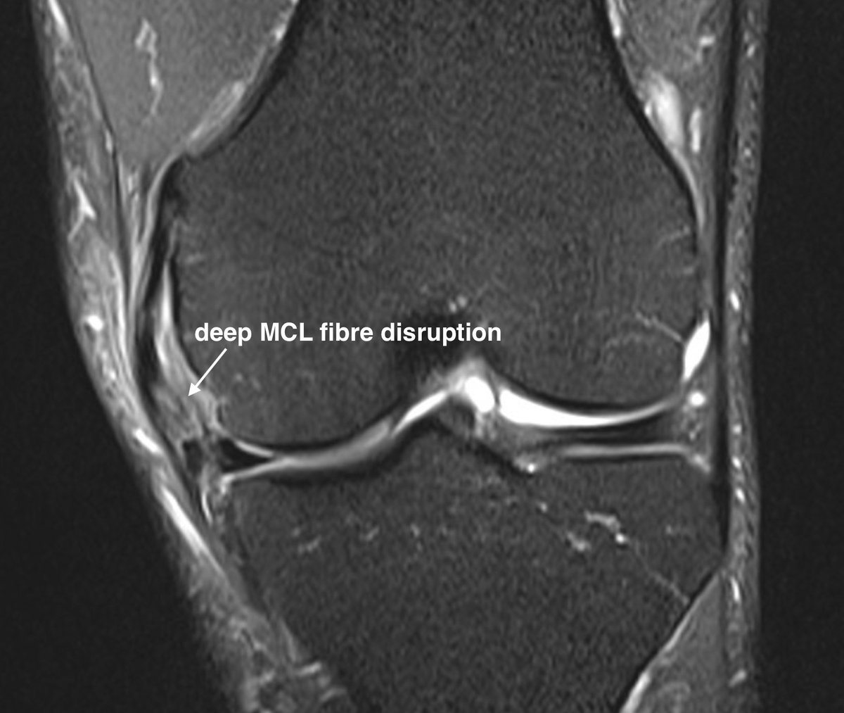Thread alert 🚨🚨🚨 - Medial knee pain! What else should we be considering ...