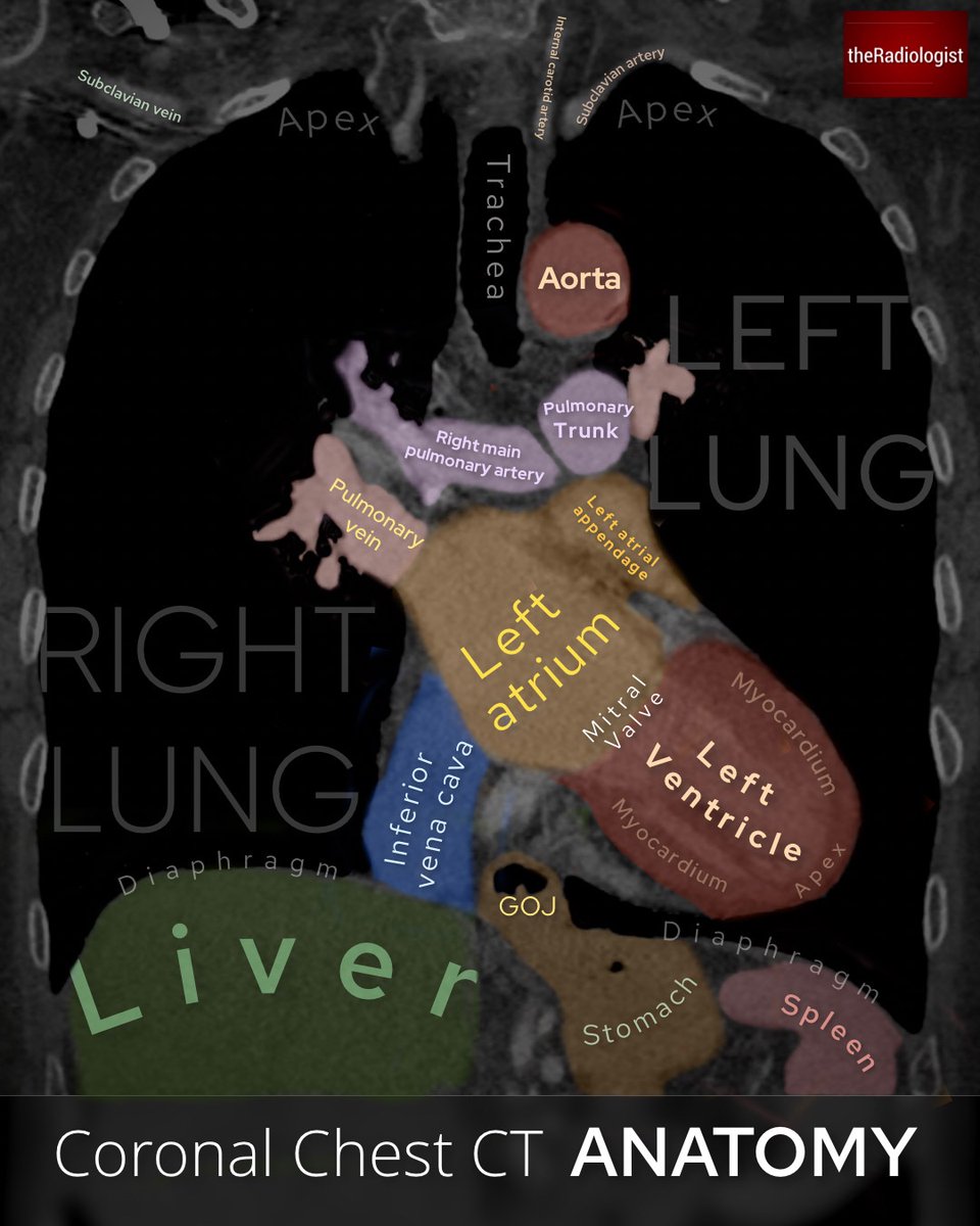 theRadiologist on Twitter: "Chest CT anatomy https://t.co/IbBveOcRqg" / Twitter