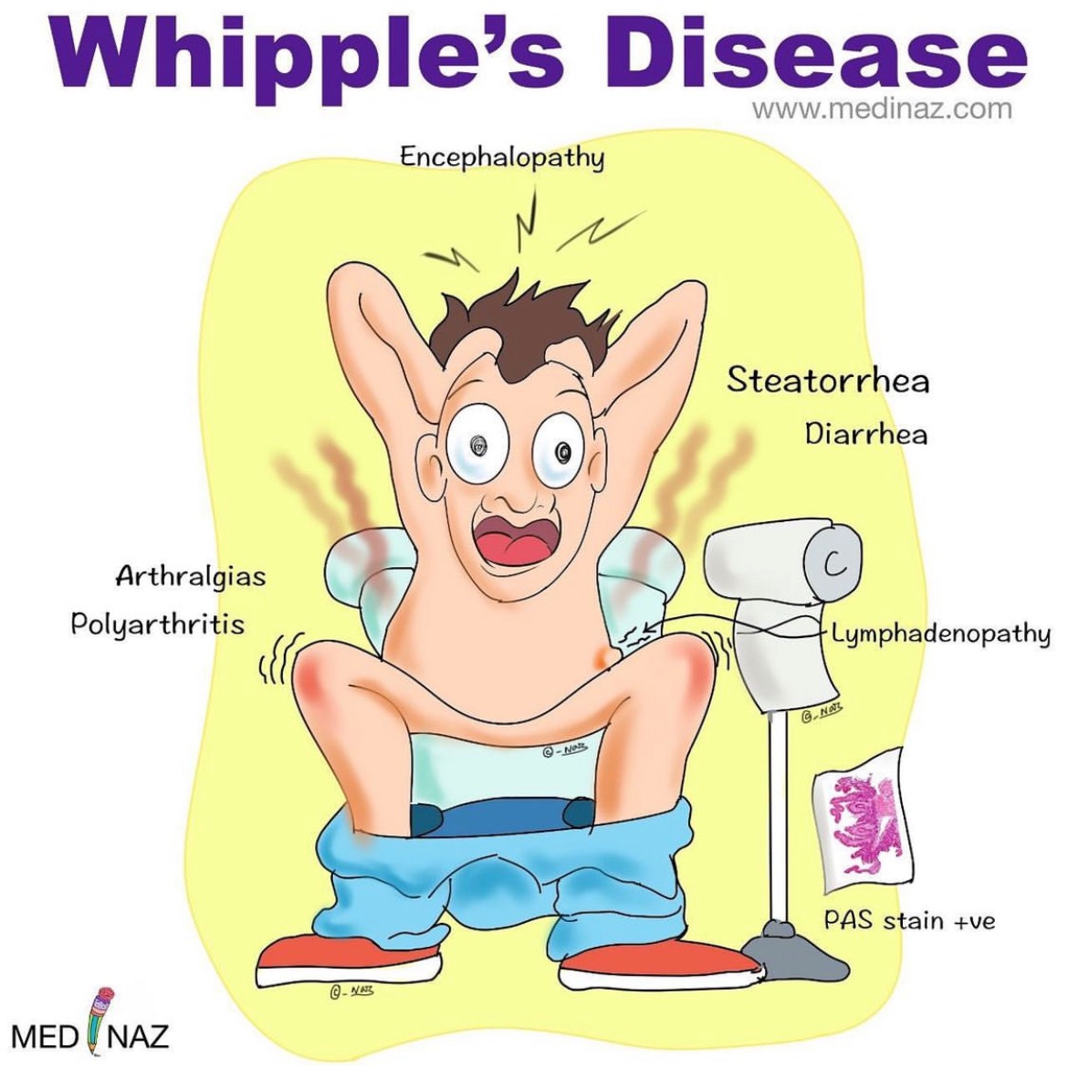Whipple Disease