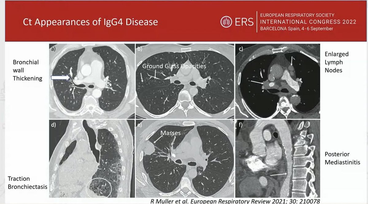MedClub on Twitter: "RT @NeumopatoGdl: La enfermedad por IgG4 es un gran simulador de tumores ...