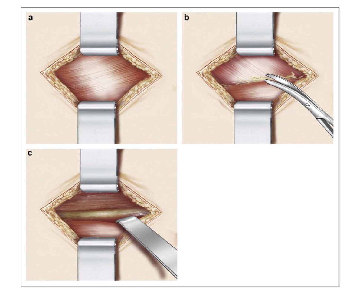 Cirbosque #SoMe4Surgery on Twitter: "Step by step: Extra peritoneal approach for minimally ...
