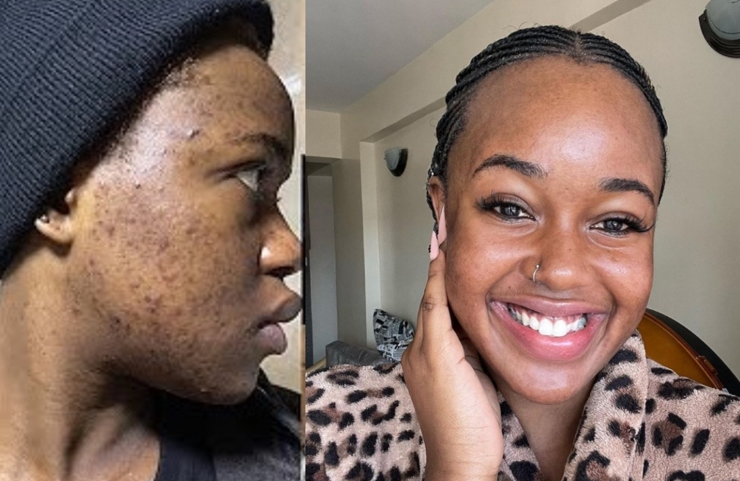 Hydroquinone Before And After Black Skin