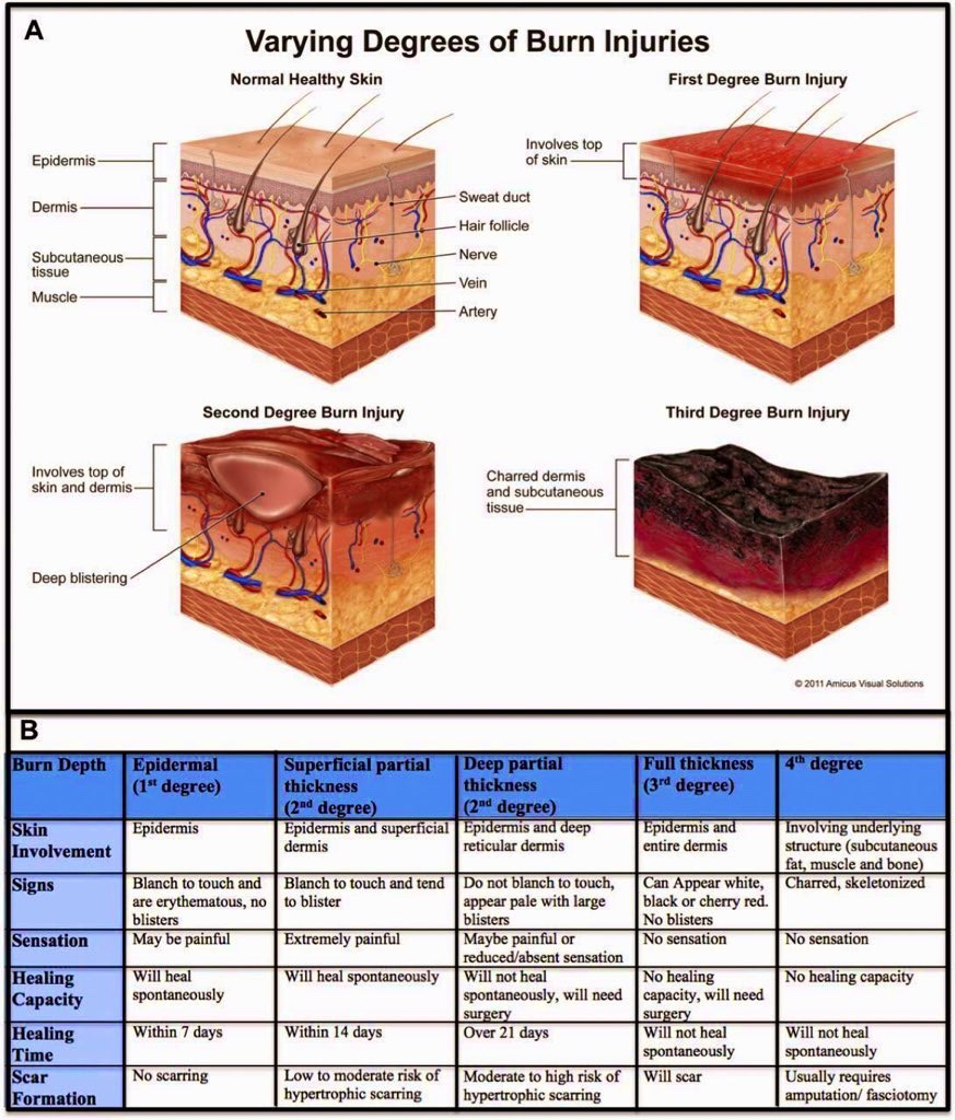 Fourth Degree Burn Diagram