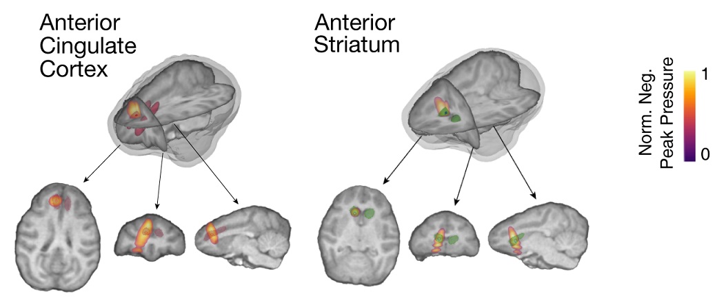 Anterior Cingulate