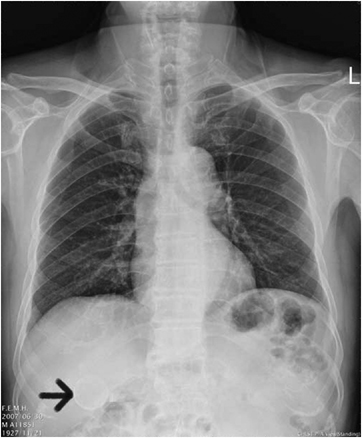 Cholelithiasis X Ray