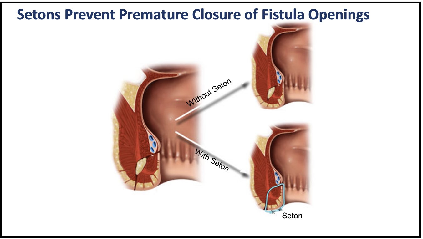 Seton Fistula