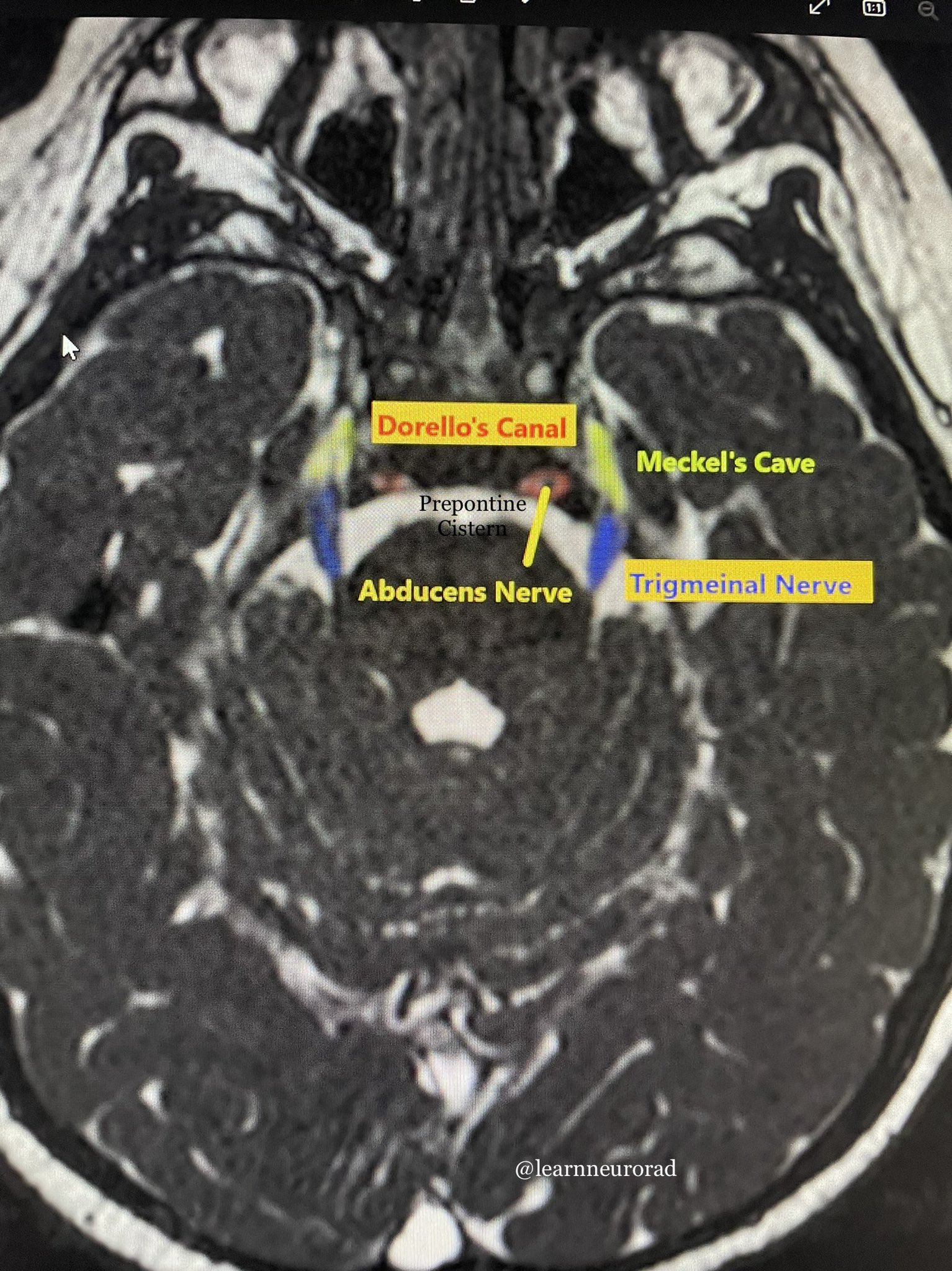 Meckels Cave Mri Anatomy