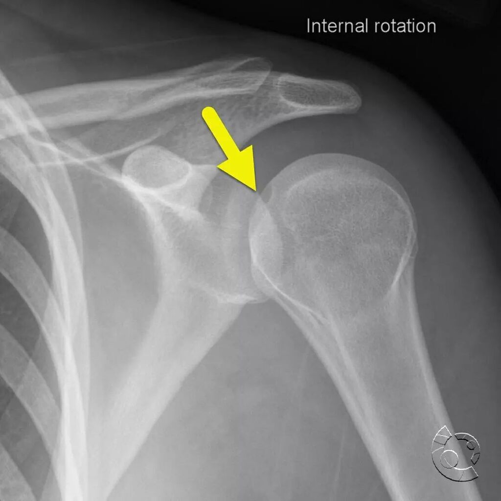 Internal Right Shoulder X Ray