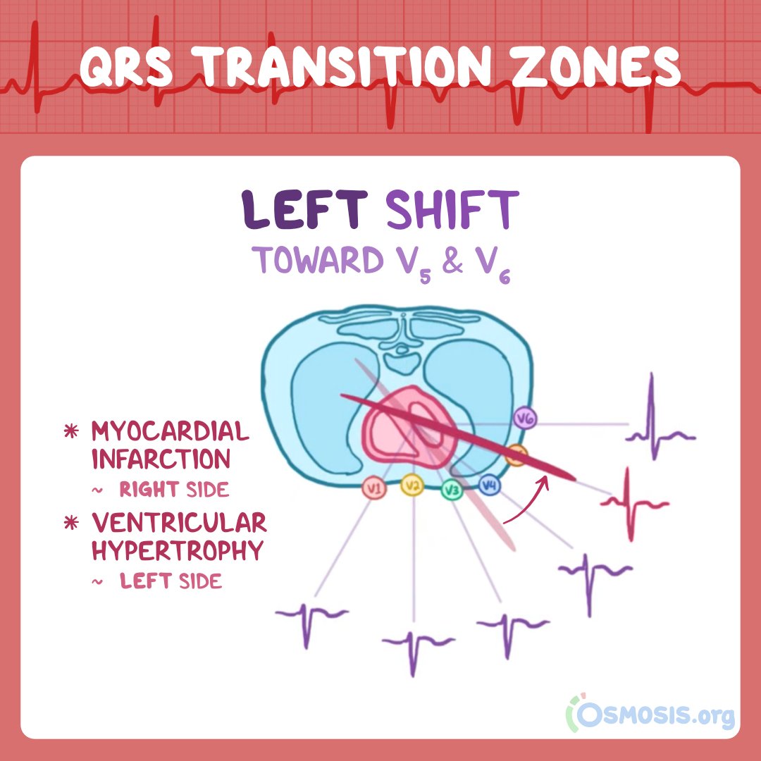 Osmosis on Twitter: "The QRS transition zone refers to where the QRS complex switches from being ...