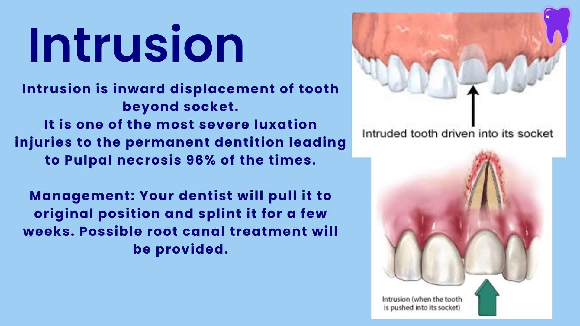 Tooth Intrusion