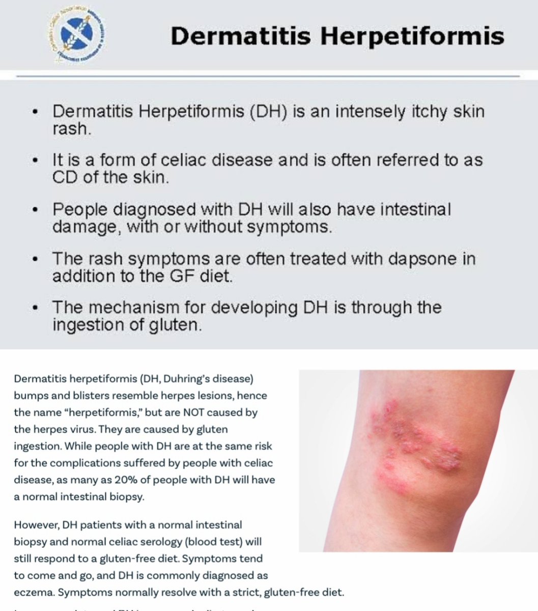 Celiac Dermatitis Herpetiformis Dermatitis Herpetiformis