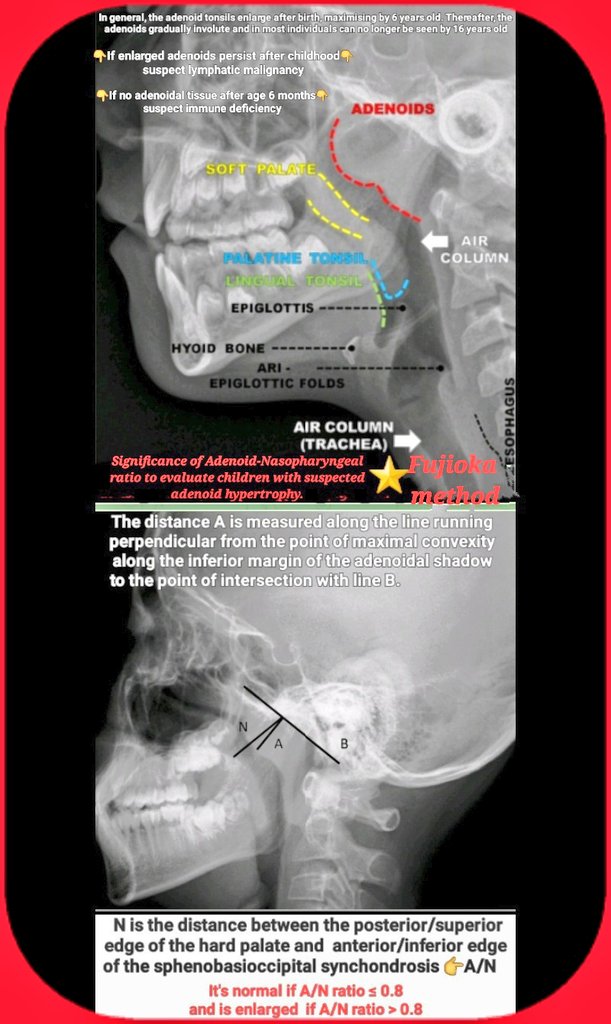 Adenoids Xray