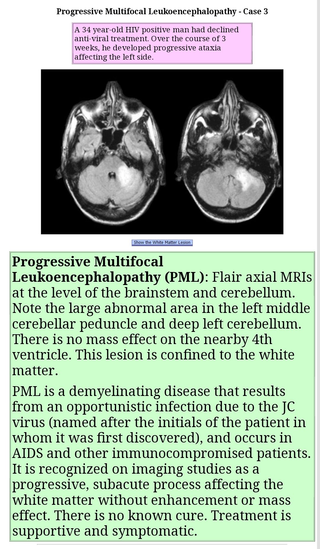 Progressive Multifocal Leukoencephalopathy Mri