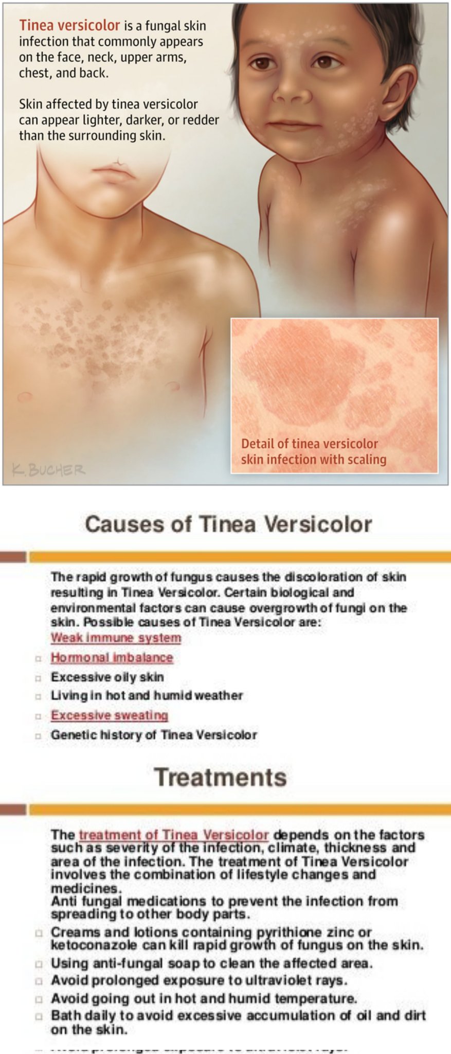 Tinea Versicolor On Face