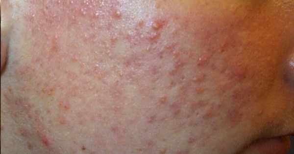 Jenis jenis jerawat dan mengenali kandungan skincare sesuai dengan ...