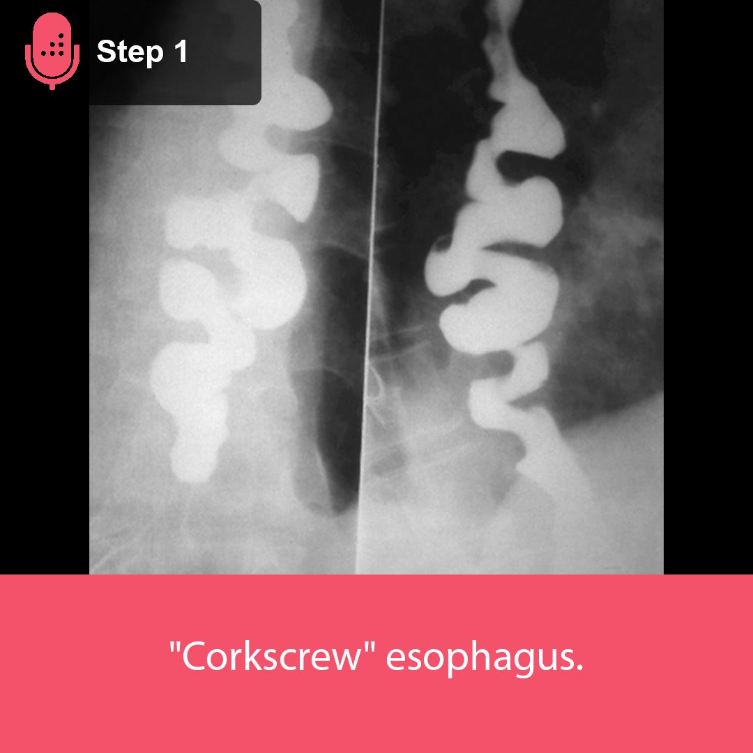 Diffuse Esophageal Spasm Barium Swallow