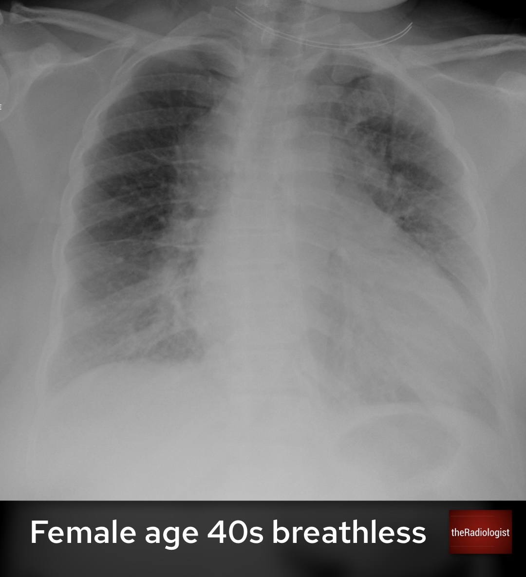 theRadiologist on Twitter: "Female in her 40s presents with acute breathlessness and has an AP ...