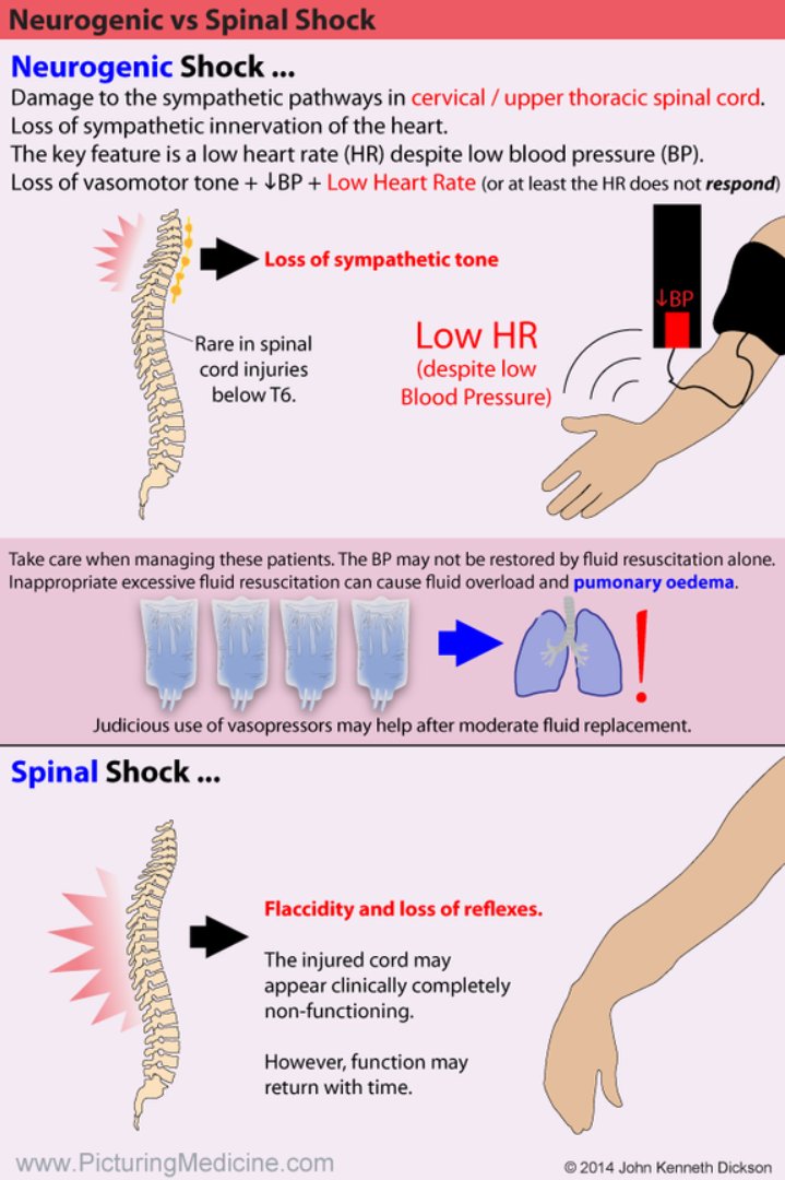 Spinal Shock