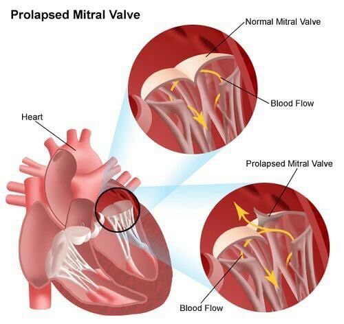 Normal Mitral Valve