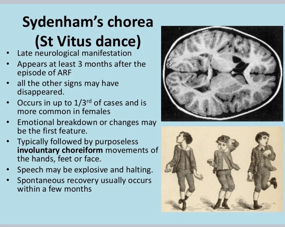 Sydenhams Chorea