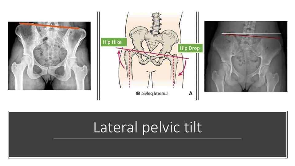 Lateral pelvic tilt في هذا الثريد بنتكلم عن #Lateral_pelvic_tilt # ...