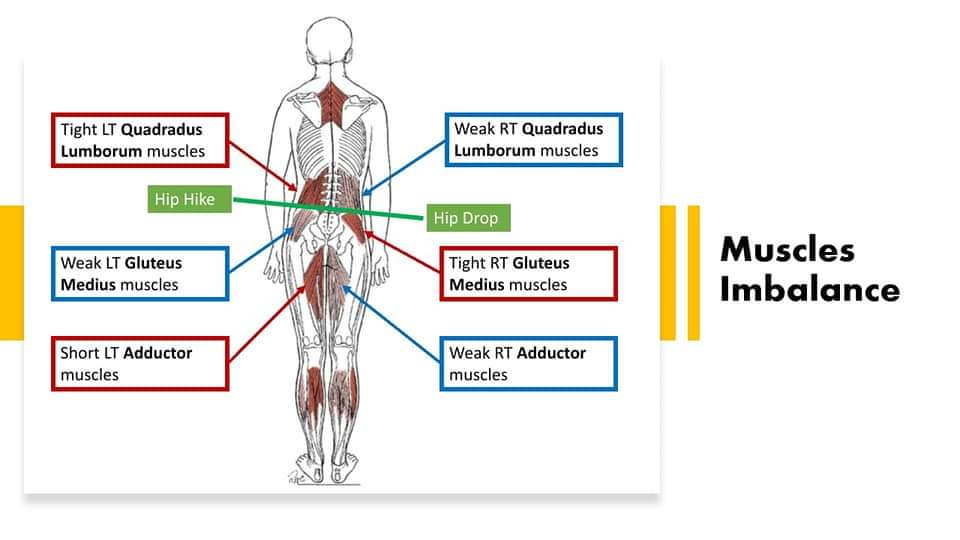 Lateral pelvic tilt في هذا الثريد بنتكلم عن #Lateral_pelvic_tilt # ...