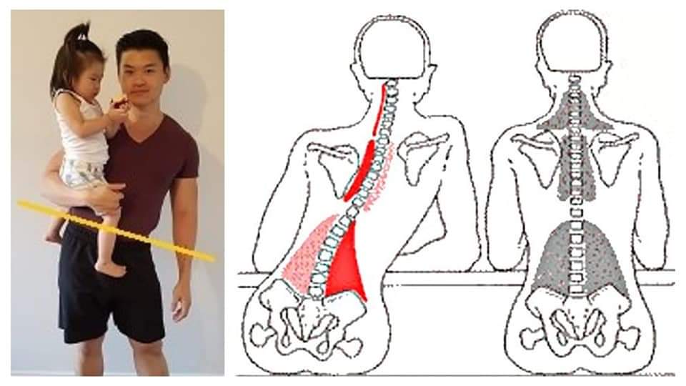 Lateral pelvic tilt في هذا الثريد بنتكلم عن #Lateral_pelvic_tilt # ...