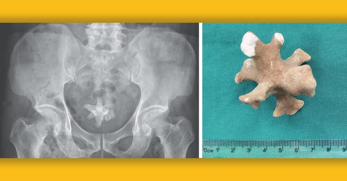Nejm On Twitter A 70 Year Old Man With Benign Prostatic Hyperplasia Was Seen For Worsening