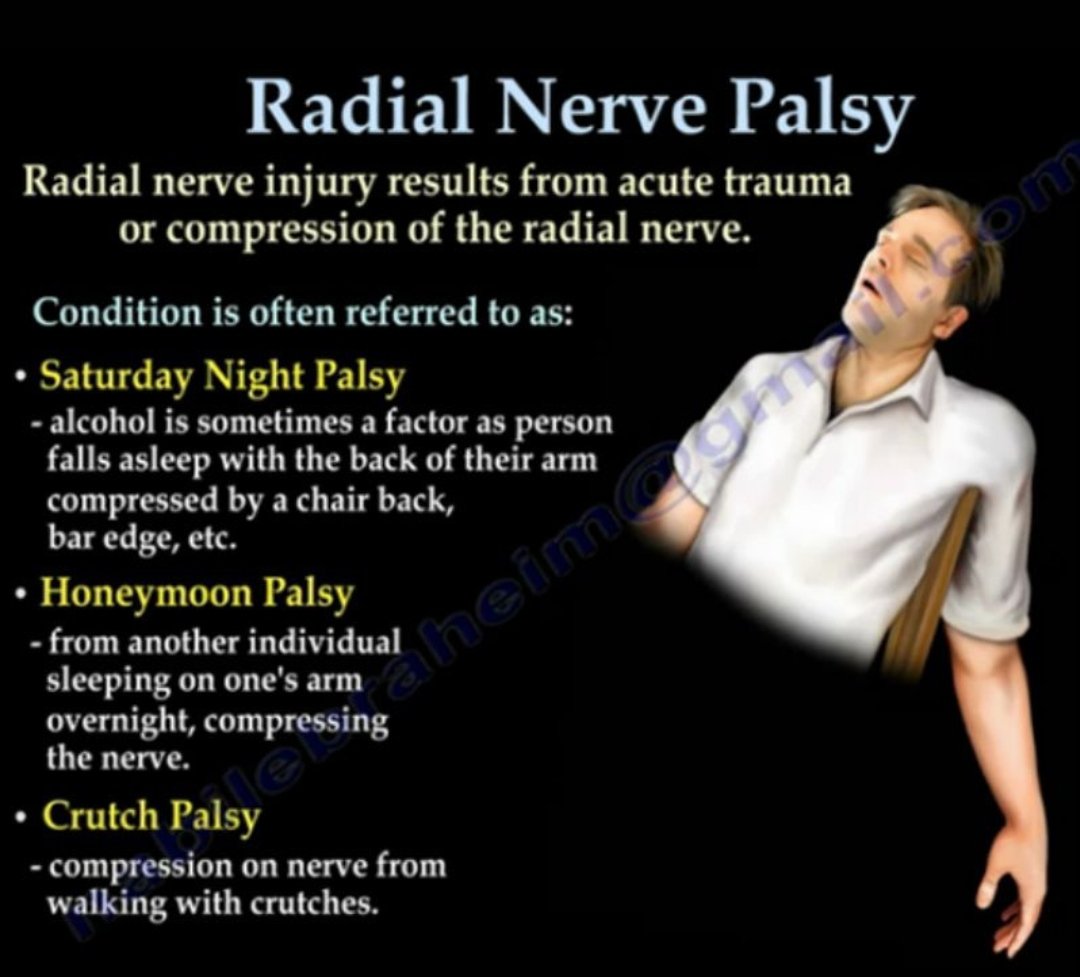 Saturday Night Palsy