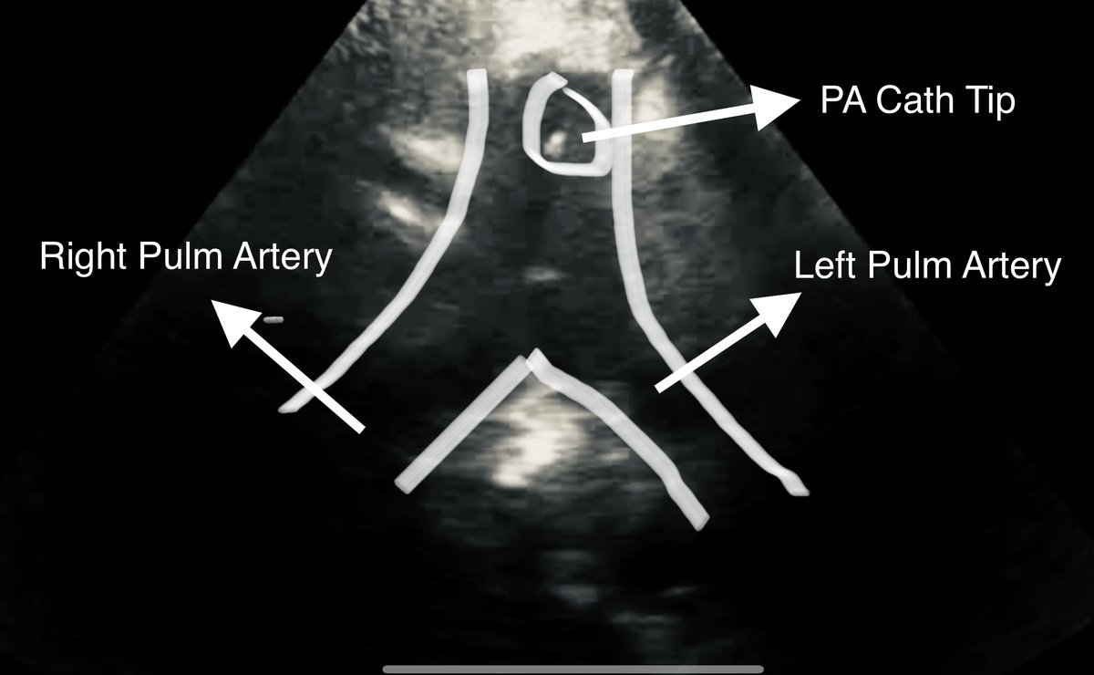 [1] A "wandering" PA catheter A pt with acute on chronic HFrEF (decline ...