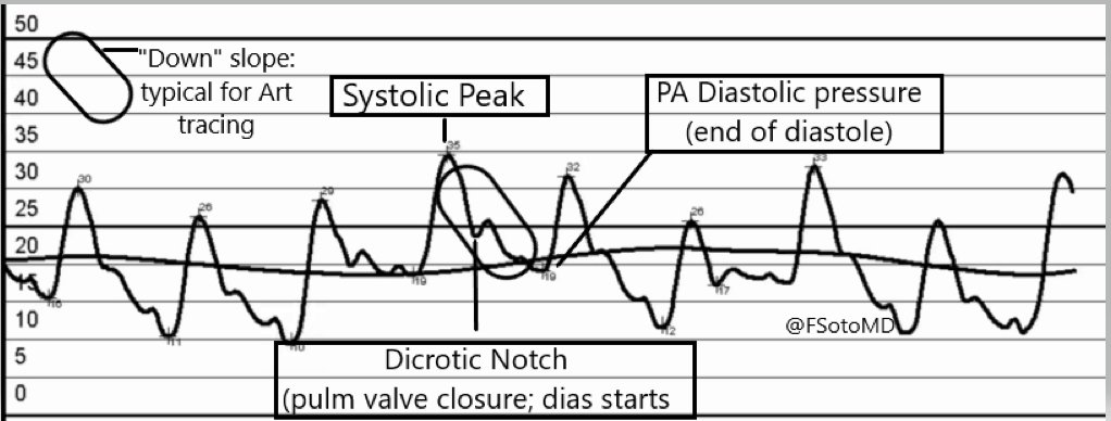 [1] A "wandering" PA catheter A pt with acute on chronic HFrEF (decline ...