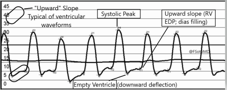 [1] A "wandering" PA catheter A pt with acute on chronic HFrEF (decline ...