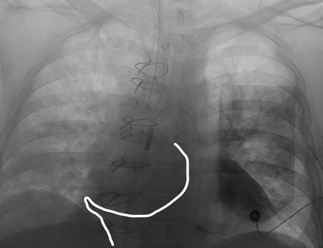 [1] A "wandering" PA catheter A pt with acute on chronic HFrEF (decline ...