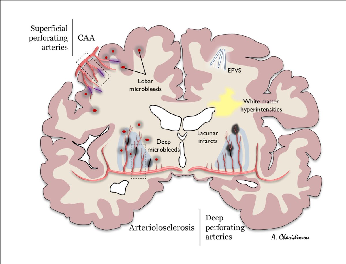 🤿🧠 Cerebral Amyloid Angiopathy (CAA) - A 'Twitter' Review 1) What is ...