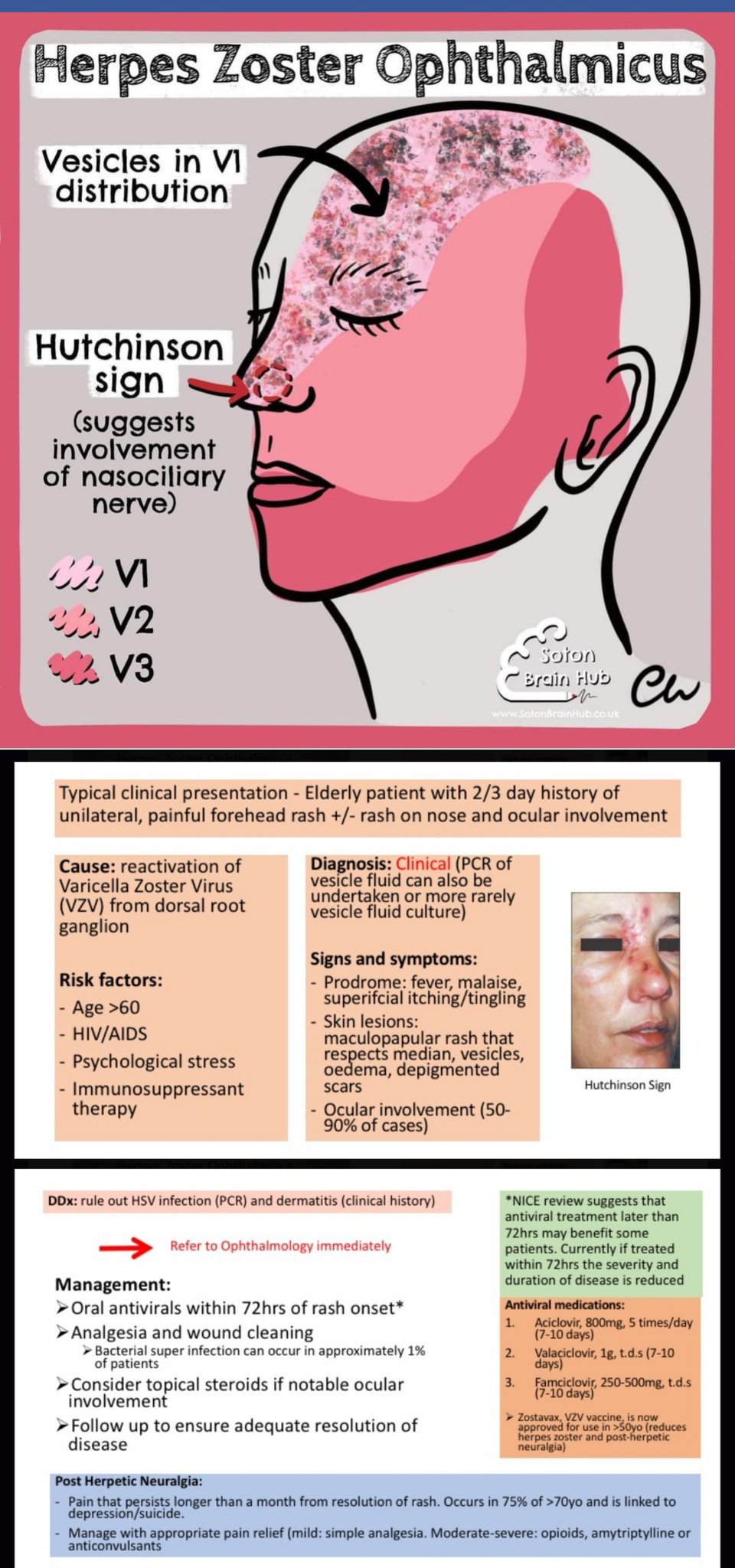 Herpes Zoster Ophthalmicus Hutchinson Sign