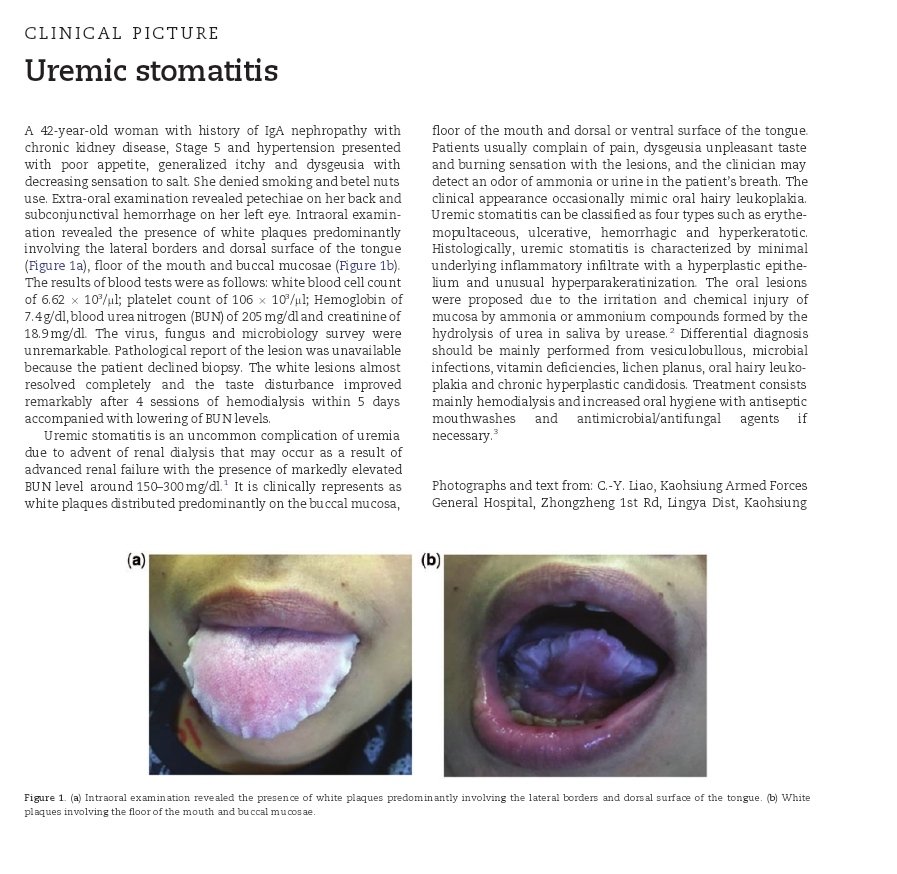Uremic Stomatitis OnLine First Uremic... Head And Neck Pathology