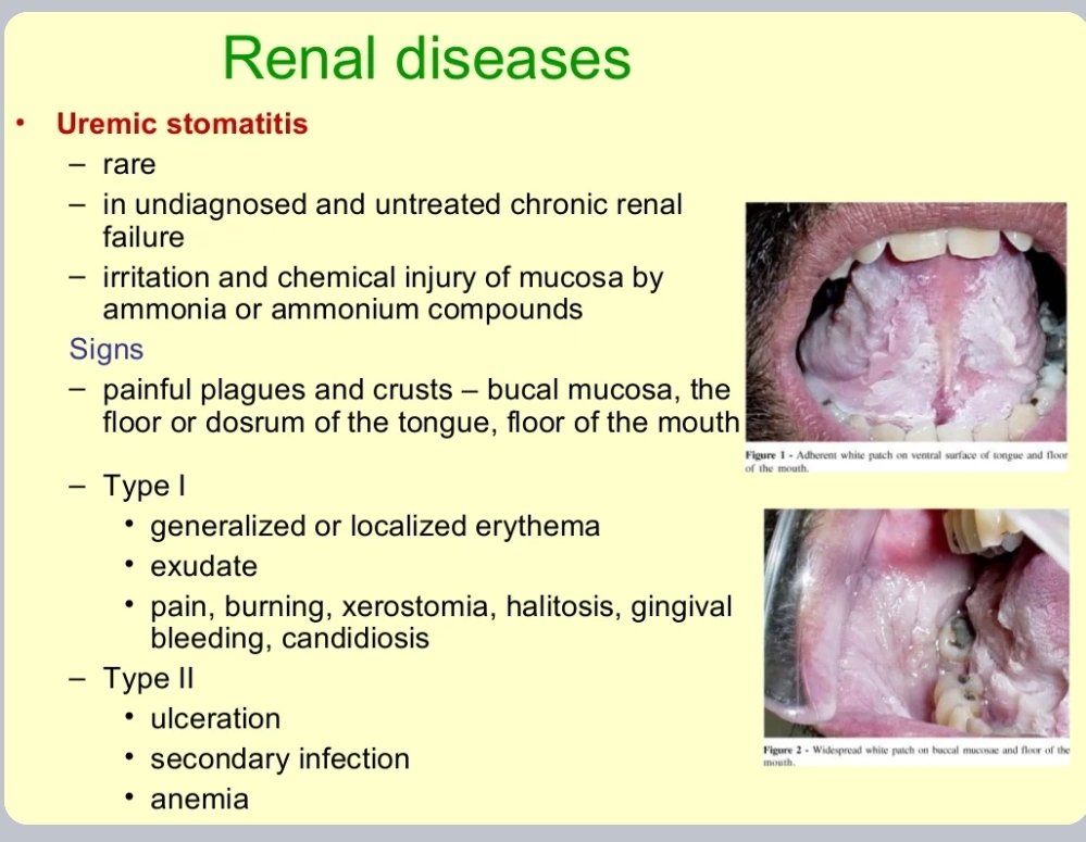 Uremic Stomatitis
