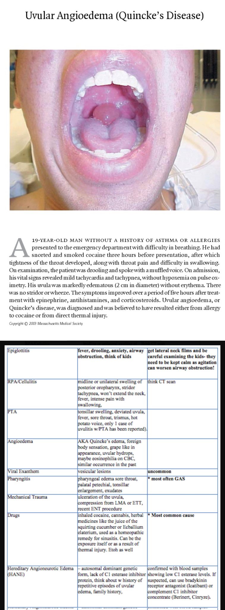 Sthanu on Twitter: "@BrownJHM @grepmeded Isolated angioedema of the uvula is termed Quincke's ...