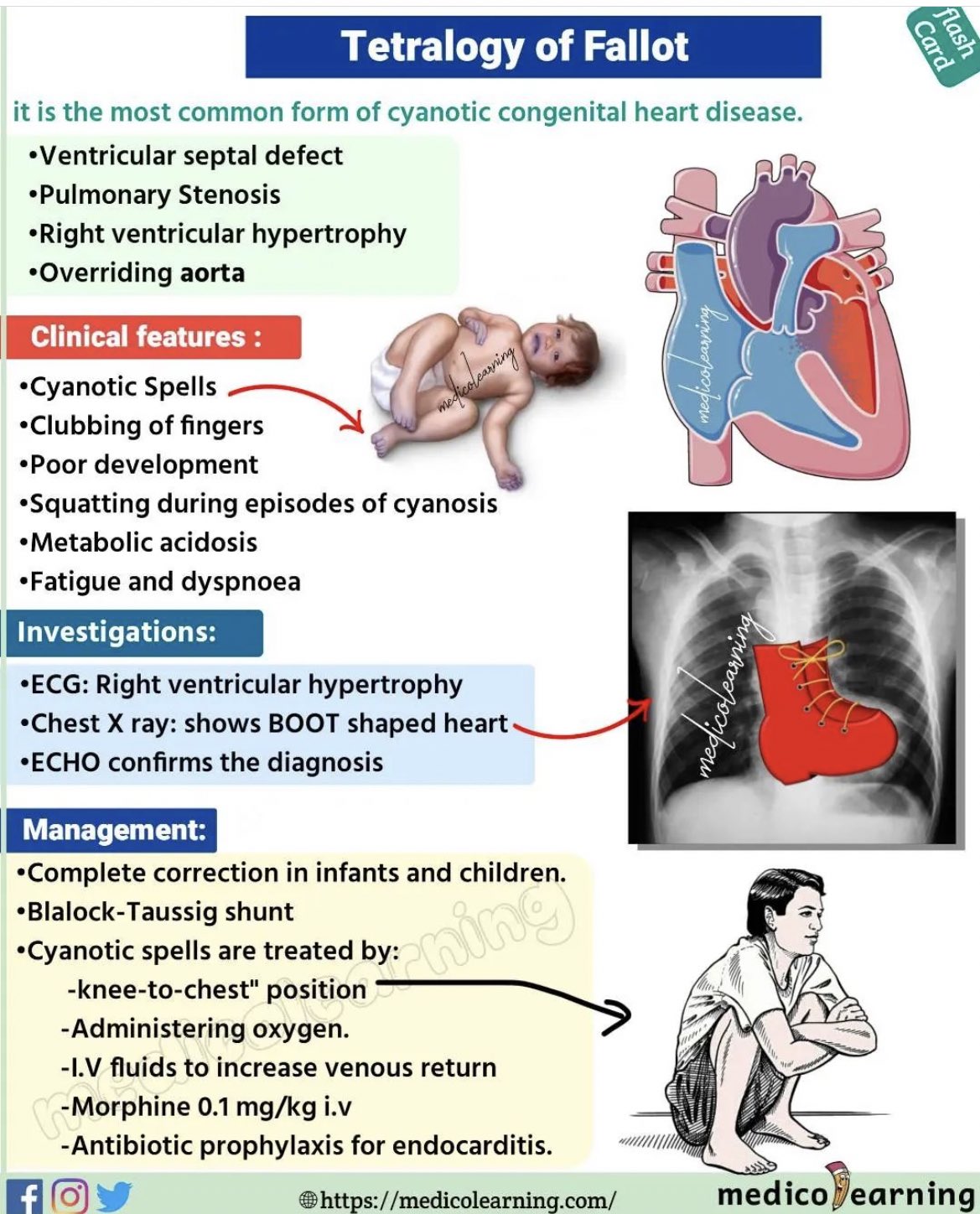 Knee Chest Position Tetralogy Fallot