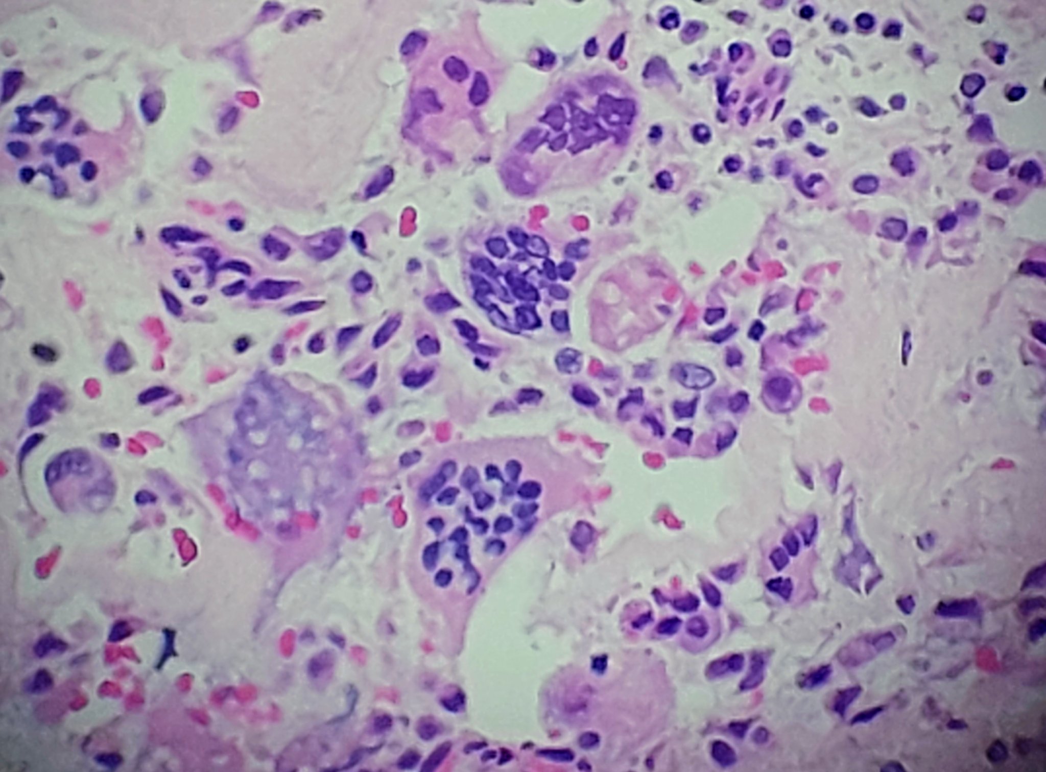 Pathology Outlines Pyogenic Granuloma Hot Sex Picture