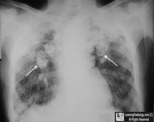 Brown Hospital Medicine On Twitter A 55 Year Old Man Who Worked As A brown-hospital-medicine-on-twitter-a-55-year-old-man-who-worked-as-a