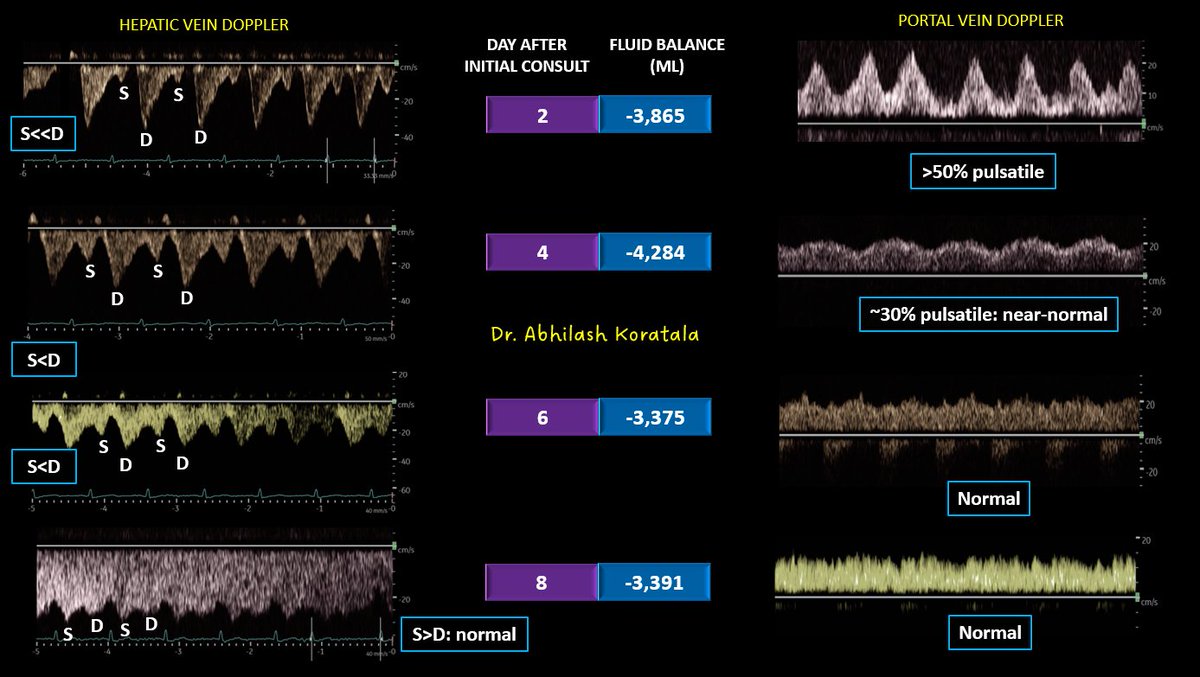 @AhmedArslanMD @ria_dancel @ASNKidney360 @nephrothaniel 1/ That's an ...