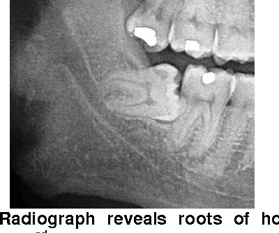العصب السنخيalveolar nerve يكون احيانا في وضع قريب جدا من ذروة جذور ...