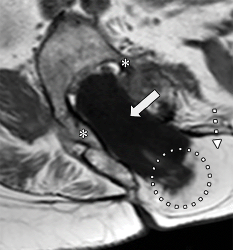 Spinal dysraphisms can be classified by whether there is an opening in ...
